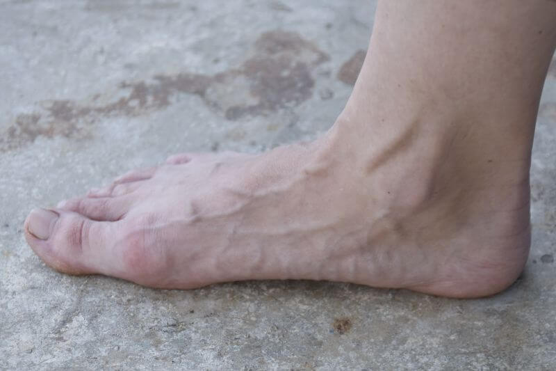 Hallux valgus = bunion | footic.com